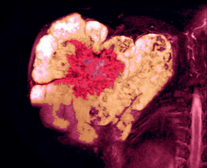Sarcoma - Central Clinic