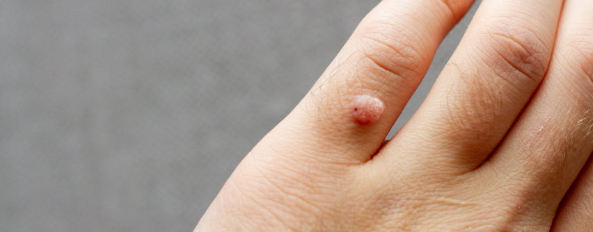 Verruga: O que é, sintomas, tratamentos e causas.