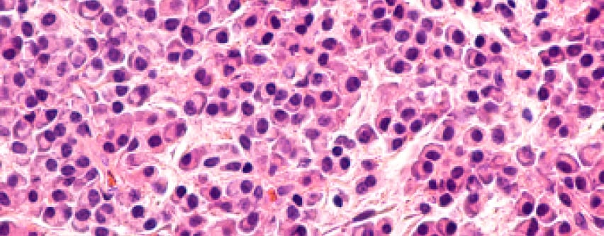 Mieloma: O que é, sintomas, tratamentos e causas.